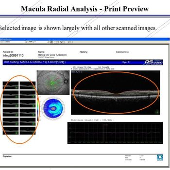 Nidek RS-3000 Advanced II | Sevest AS